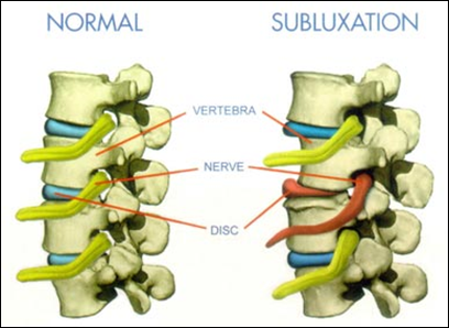 Priority Health Chiropractic and Massage: Subluxation Degeneration and ...